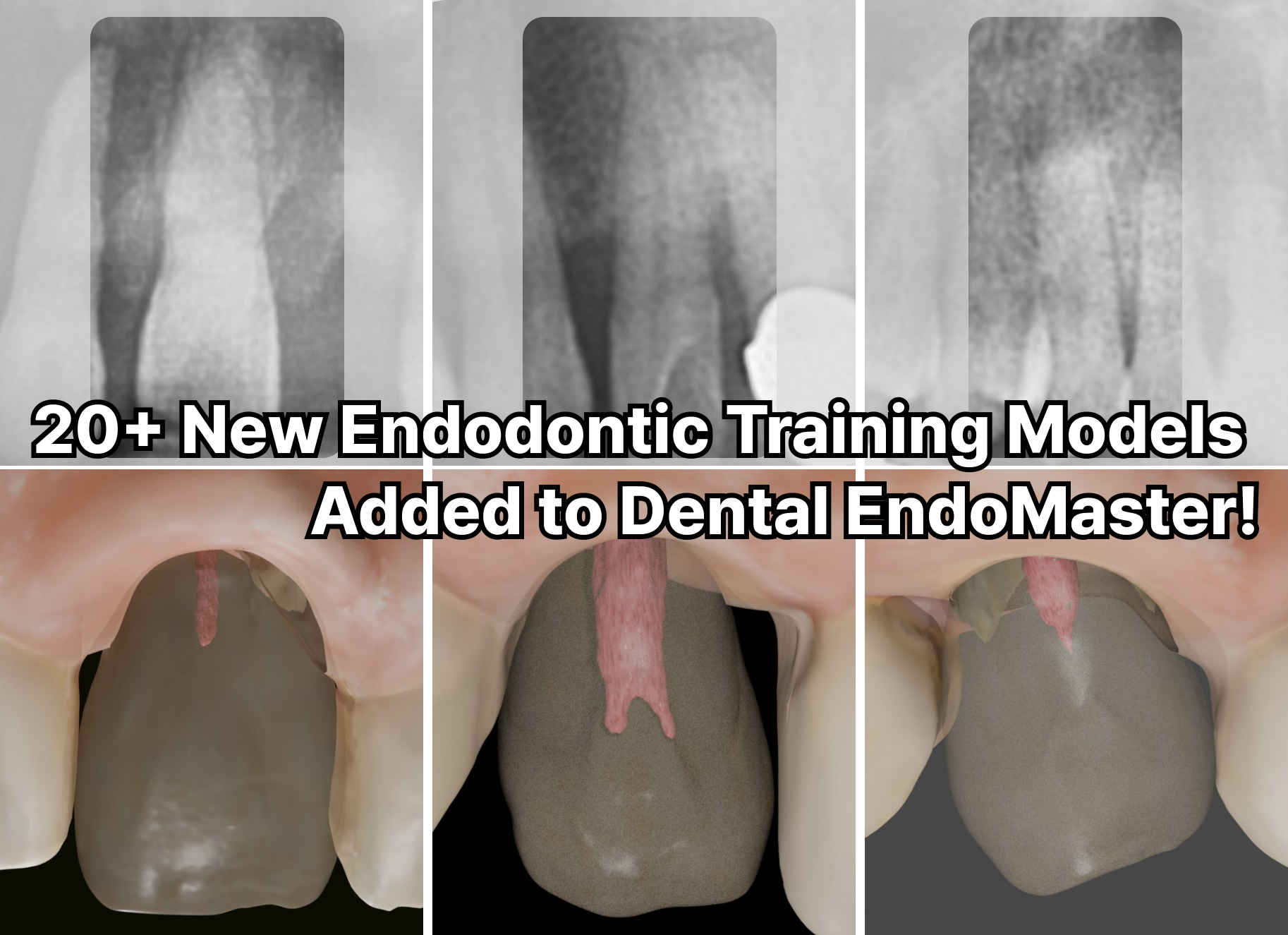 Exciting News: 20 New Endodontic Training Models Added to Dental ...