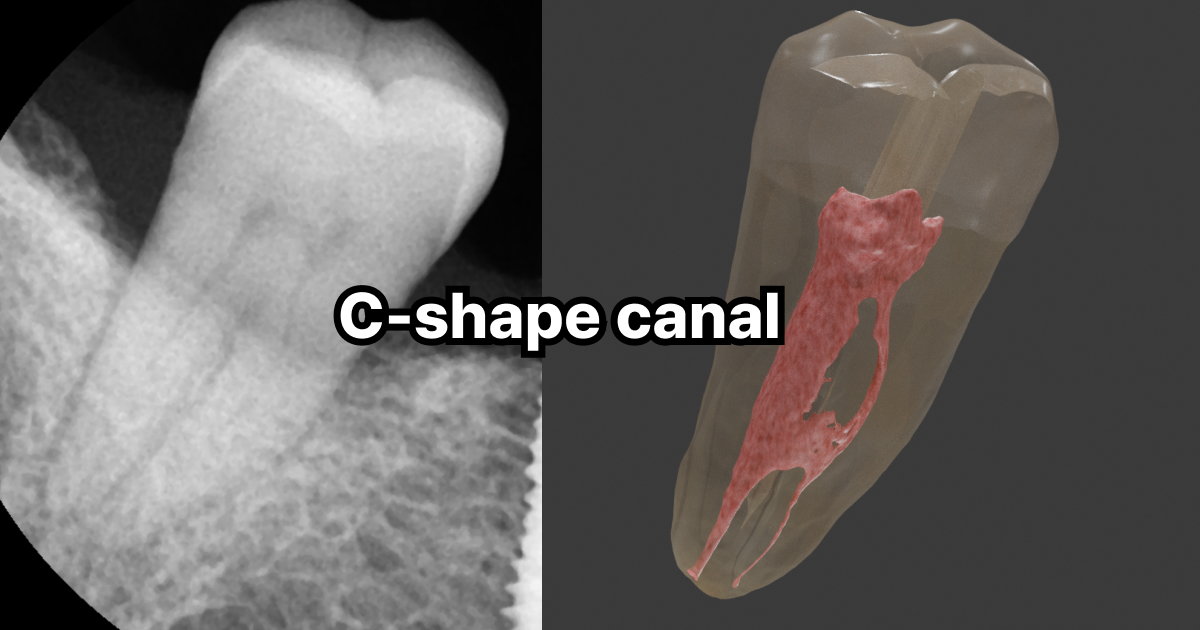 Tooth Anatomy and Dental EndoMaster: C-shaped Canal - Dental Master Series